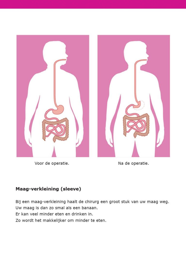 Praatkaart maagverkleining - Pharos